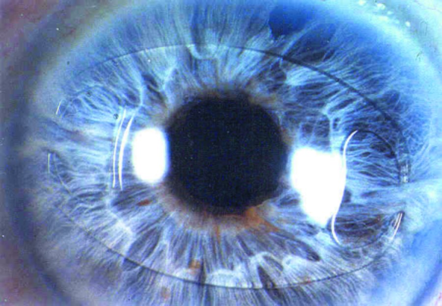 Few Long-Term Options for Children with Aphakia Lacking Capsular Support – ARTISAN® Aphakia IOL ...